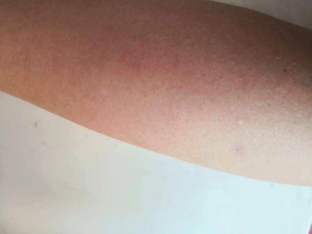 胳膊上有小白点是怎么回事？ 搜狐大视野 搜狐新闻