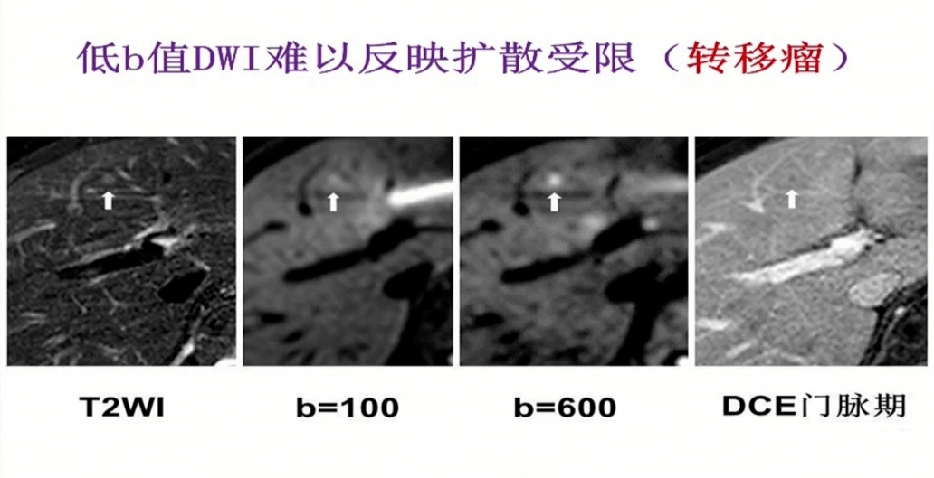 DWI序列上不同b值对于显示病灶的意义-搜狐大视野-搜狐新闻