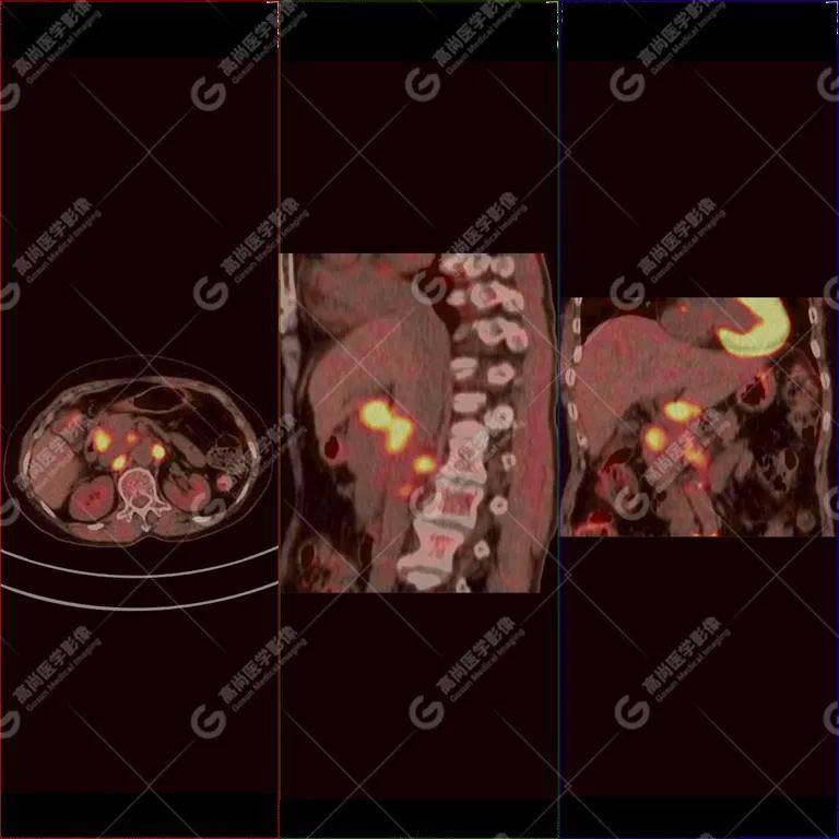 【高尚病例】PET/CT发现胆囊癌并淋巴结转移1例_诊断_密度_恶性肿瘤