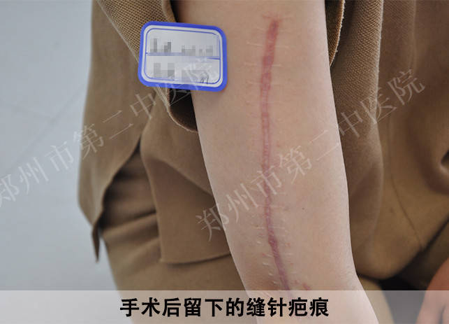 郑州市第二中医院:缝针疤痕怎么才能去除伤口组织皮肤