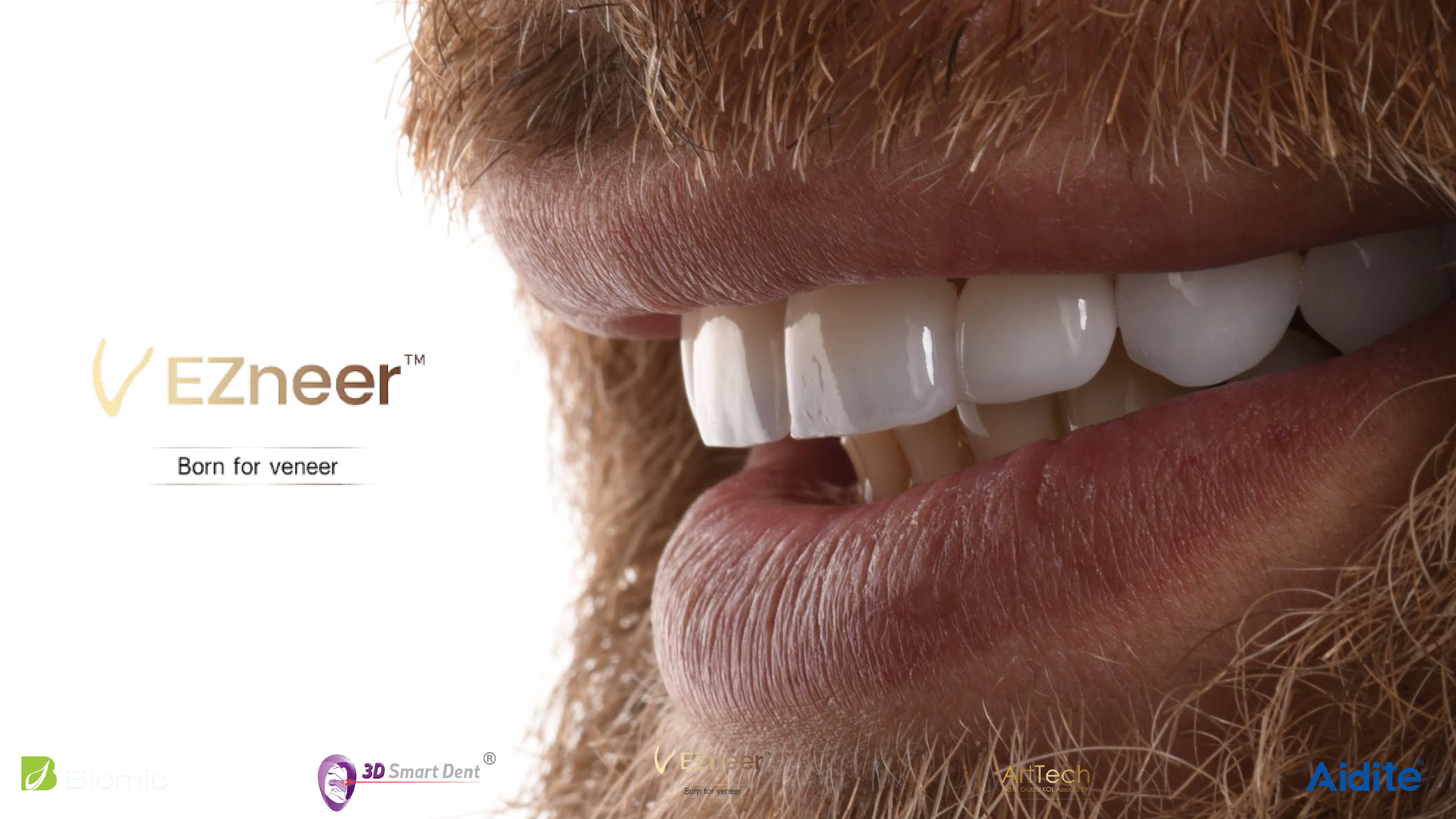 爱迪特 #EZneer病例赏析# Born for veneer!-搜狐大视野-搜狐新闻