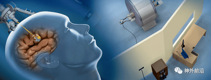 NeuroSurgery：百例患者回顾性研究证明LITT是治疗颅内肿瘤和癫痫等病种的新手段 - 天坛医院张凯点评_手术