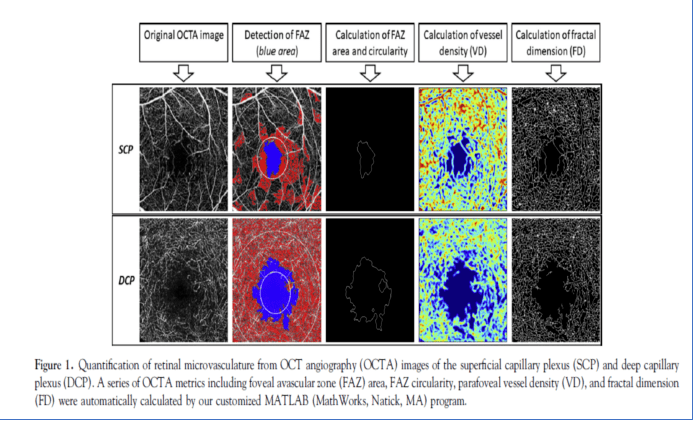 OCTA之于DR和DME患者管理的重要意义_基线