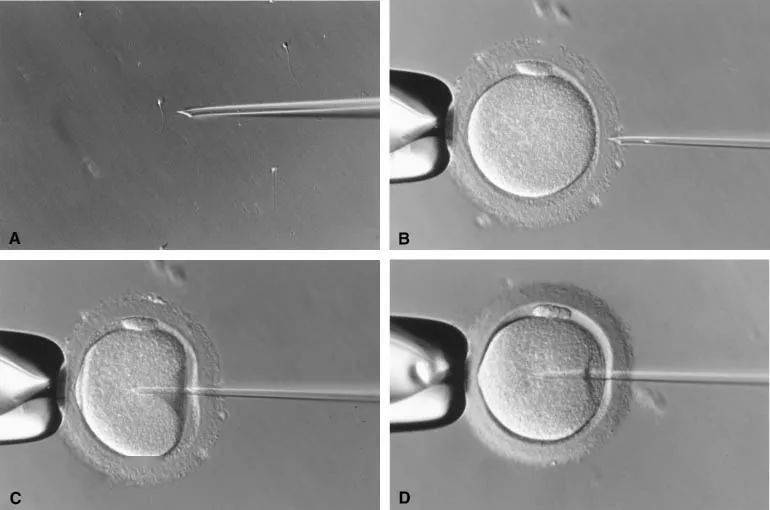 【山东中医药大学二附院生殖医学科】显微取精——“无中生有”取得真“精”_精子