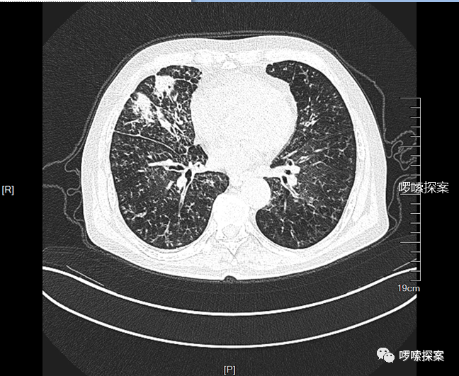 百闻不如一见，CT展示典型的DPB_双下