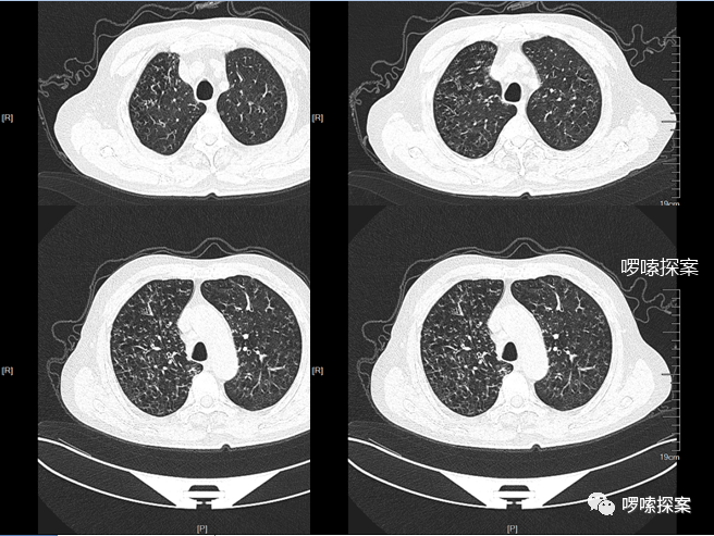 百闻不如一见，CT展示典型的DPB_双下