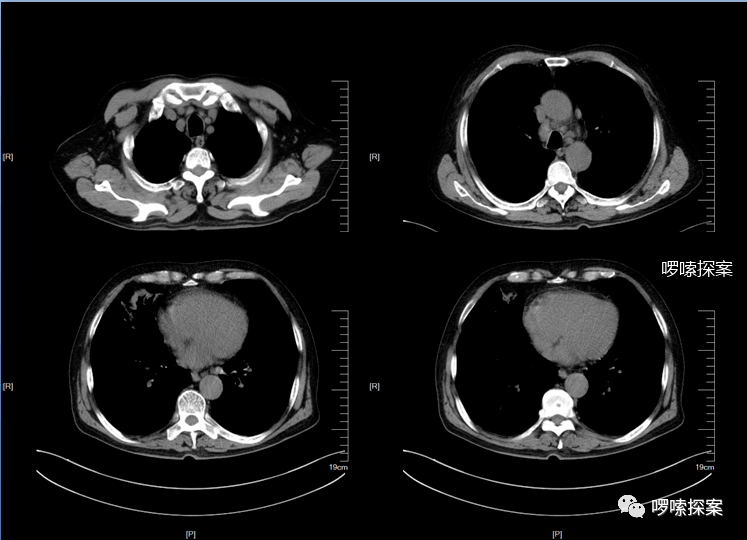 百闻不如一见，CT展示典型的DPB_双下