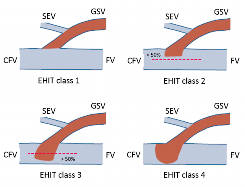 Endovascology 2020｜Sandeep Raj Pandey：静脉腔内热引发血栓形成_治疗