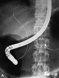 郦枫教授“ERCP 插管理念及技巧”学习笔记（2020浙江国际EUS学术大会）_乳头