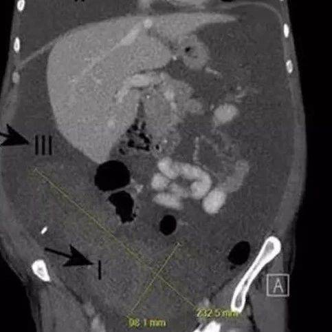 梅格斯综合征_Meigs