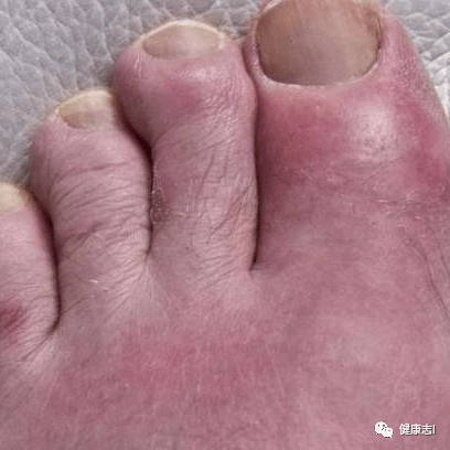 大脚趾疼痛，是痛风的首发症状，不以为意小心造成残疾尿酸关节饮食 5436