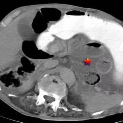 Treitz疝_肠系膜_十二指肠_血管