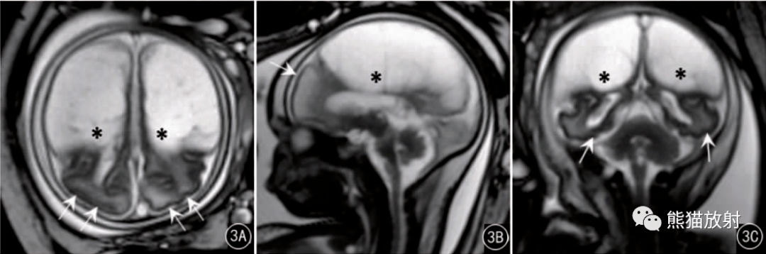 胎儿大脑皮质发育畸形丨产前MRI诊断_脑沟_显示_病例
