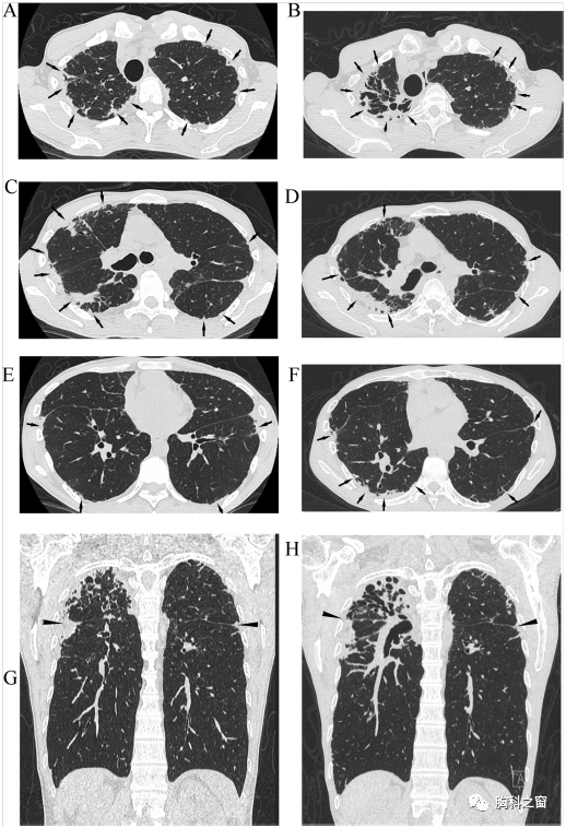 日常实践中CT上的胸膜肺实质弹力纤维增生症（PPFE）样表现——患病率和系列变化_进展_患者_图像
