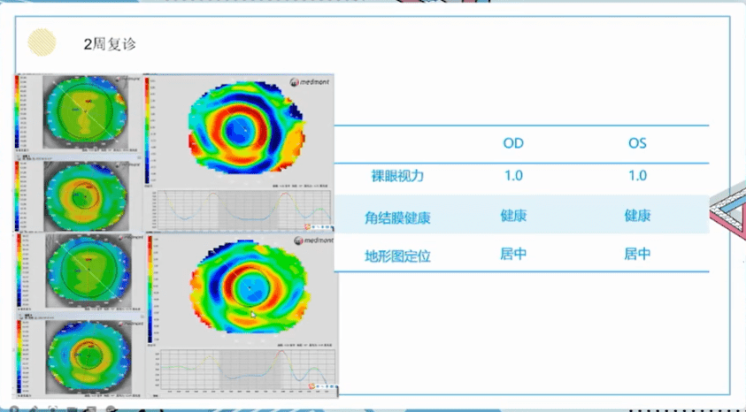 【星月谈】首期，视达佳智慧定制角膜塑形镜案例及验配心得精彩回顾_镜片_mm_医生