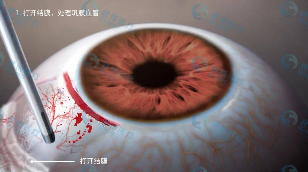 iTrack手术图解：穿透性 Schlemm′s 管成形术（PCP）_巩膜_角膜_眼压