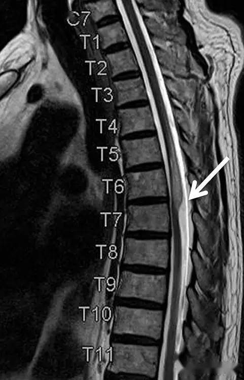 手术刀征：背侧蛛网膜网带_the_cord_of