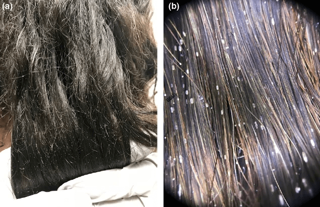 头发发根的小白点，是我那为数不多的毛囊吗？_头皮_毛发_情况