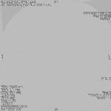 HyperForm封堵球囊系统辅助栓塞大脑前动脉A1段动脉瘤_造影_导管_mmHg