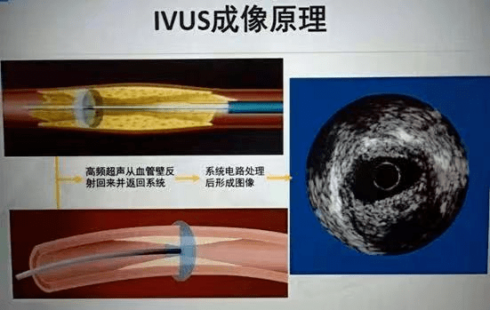 科普｜心内科医生的“火眼金睛”-冠脉内超声（IVUS）_胡大叔_血管_检查