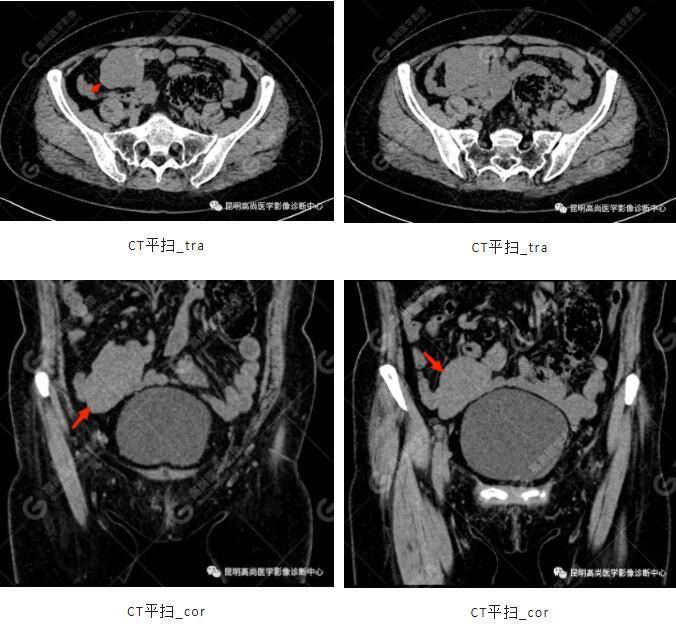 58岁女性，行下腹CT平扫+增强检查：小肠间质瘤_诊断_肿瘤_治疗