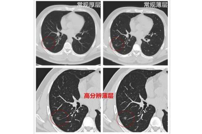 疾病诊断又添“侦察兵”！Optima CT620上线-搜狐大视野-搜狐新闻