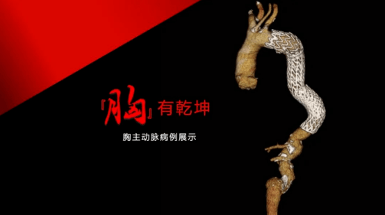美敦力VS戈尔：开始腹主动脉覆膜支架临床_患者_医疗_产品
