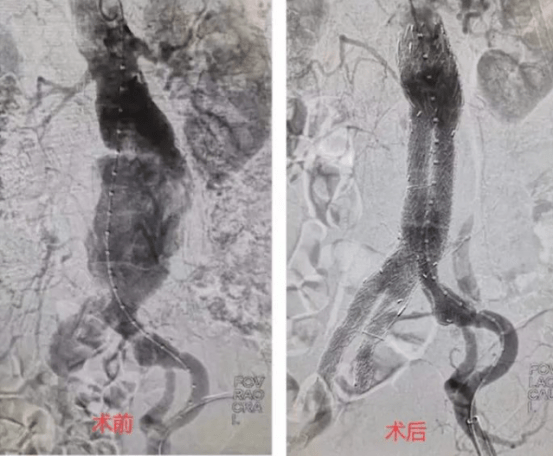美敦力VS戈尔：开始腹主动脉覆膜支架临床_患者_医疗_产品