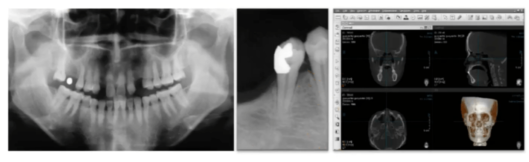 学种植，要先会看CBCT、曲断片、根尖片_断层_骨密度_口腔