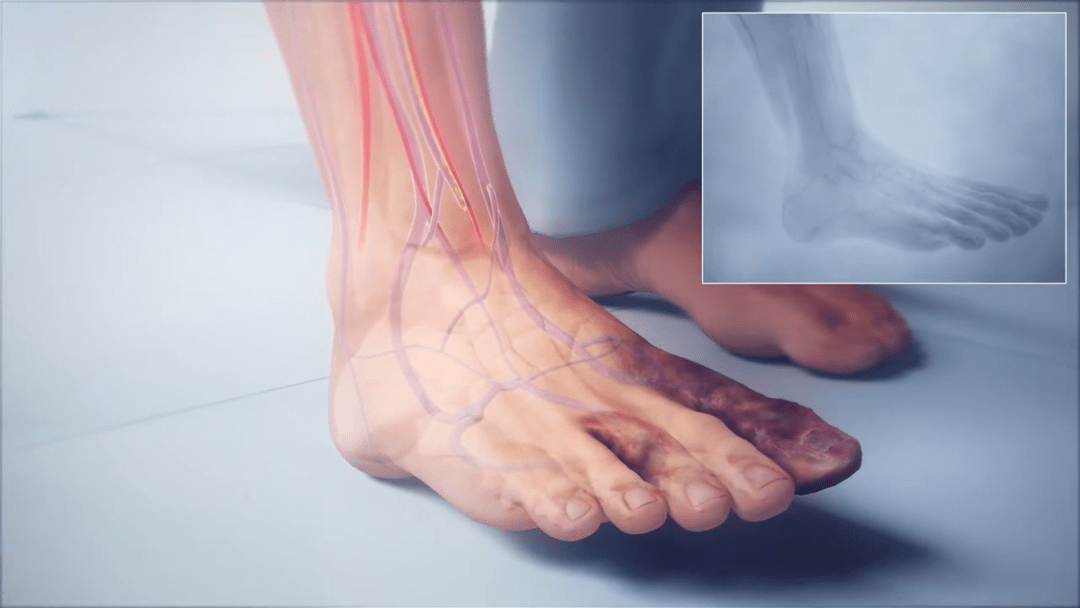 30亿！血管介入治疗行家收购LimFlow_血栓_导管_Inari