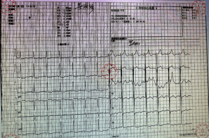 “贞”心一“课”｜TAVR治疗Type 0型二叶瓣主动脉瓣狭窄1例_mmHg_患者_瓣膜