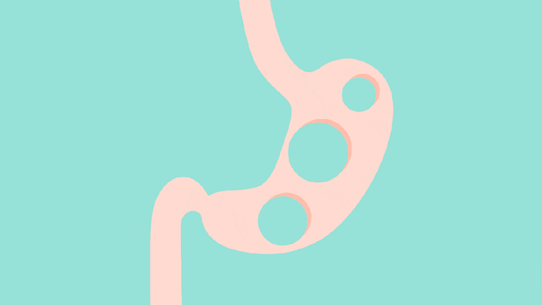 提醒！空腹吃这6种食物，容易吃出“胃结石”_柿子_患者_成分